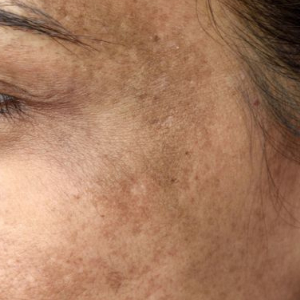 PIGMENTATION – SMASH SKIN